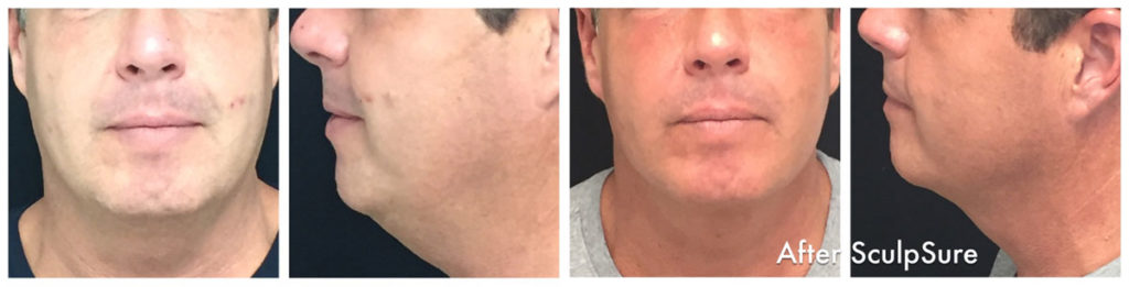 SculpSure | Susan E. Neil, MD